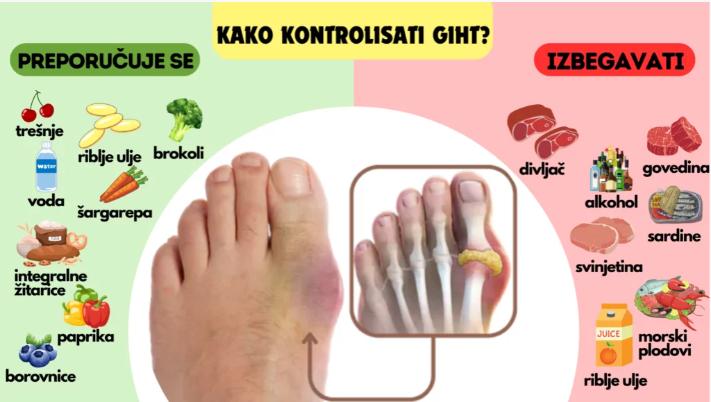 Prirodno lečenje gihta - Marbal Health